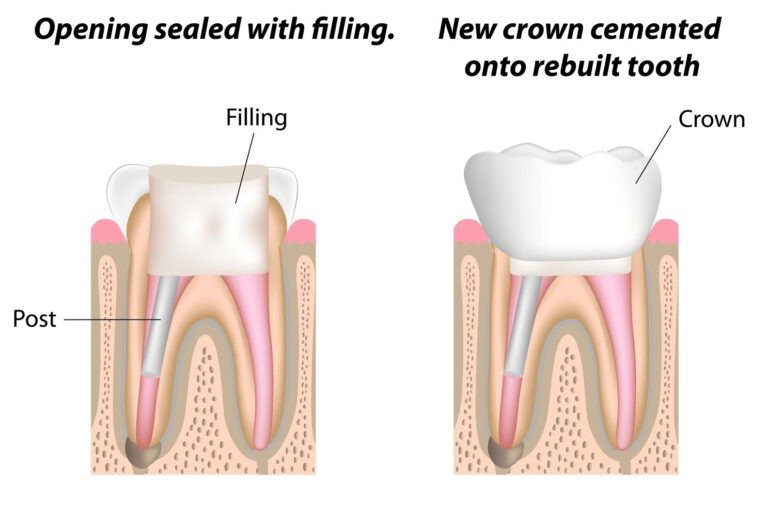 ENDODONTICS - Root Canal Treatment | Ilford, Essex